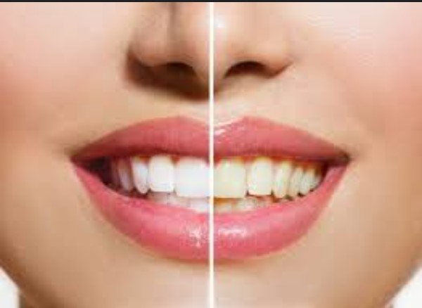 Teeth Whitening Singapore Before and After (What to Expect) - iEnglish ...